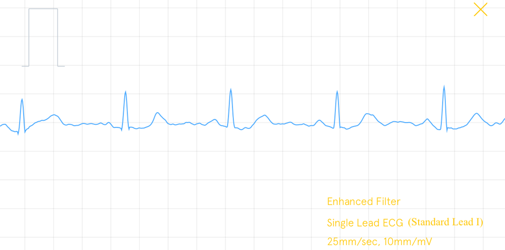 Review: Kito+, the iPhone case that doubles as a portable ECG machine ...